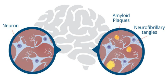 How Brain Trash Affects Your Brain